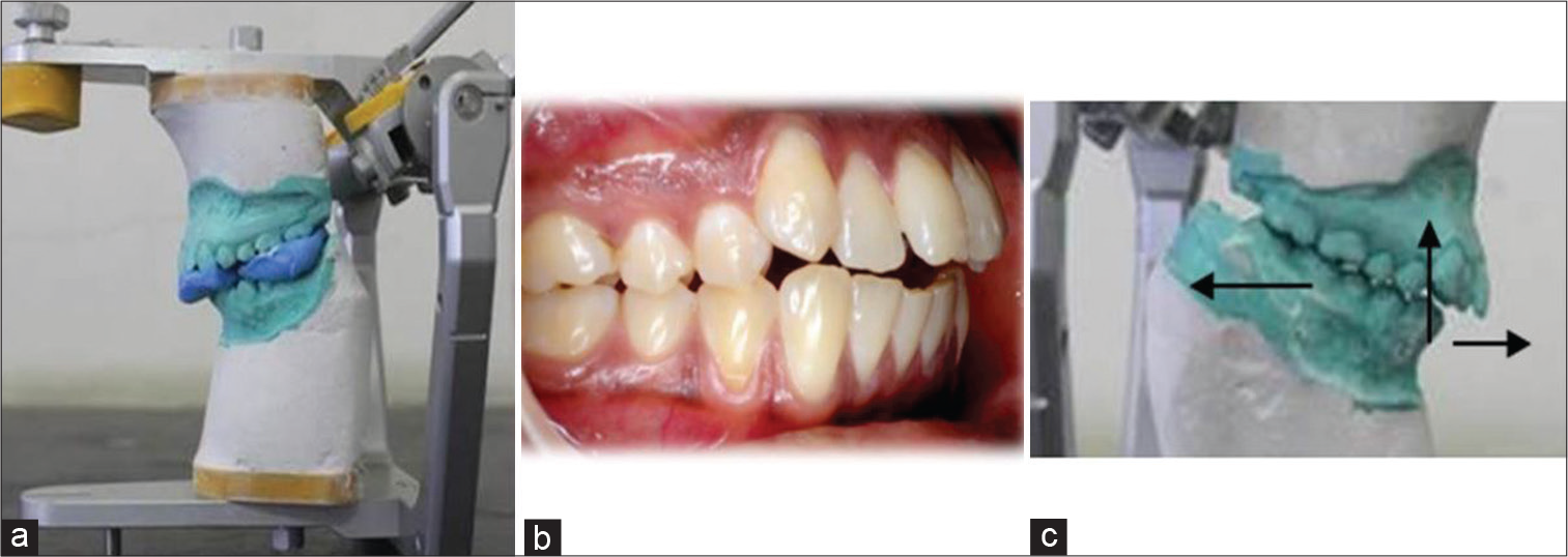 Orthodontic diagnosis and management of TMJ – A case report - Sri ...